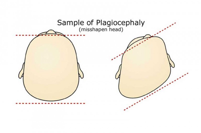 Head Asymmetry or Plagiocephaly